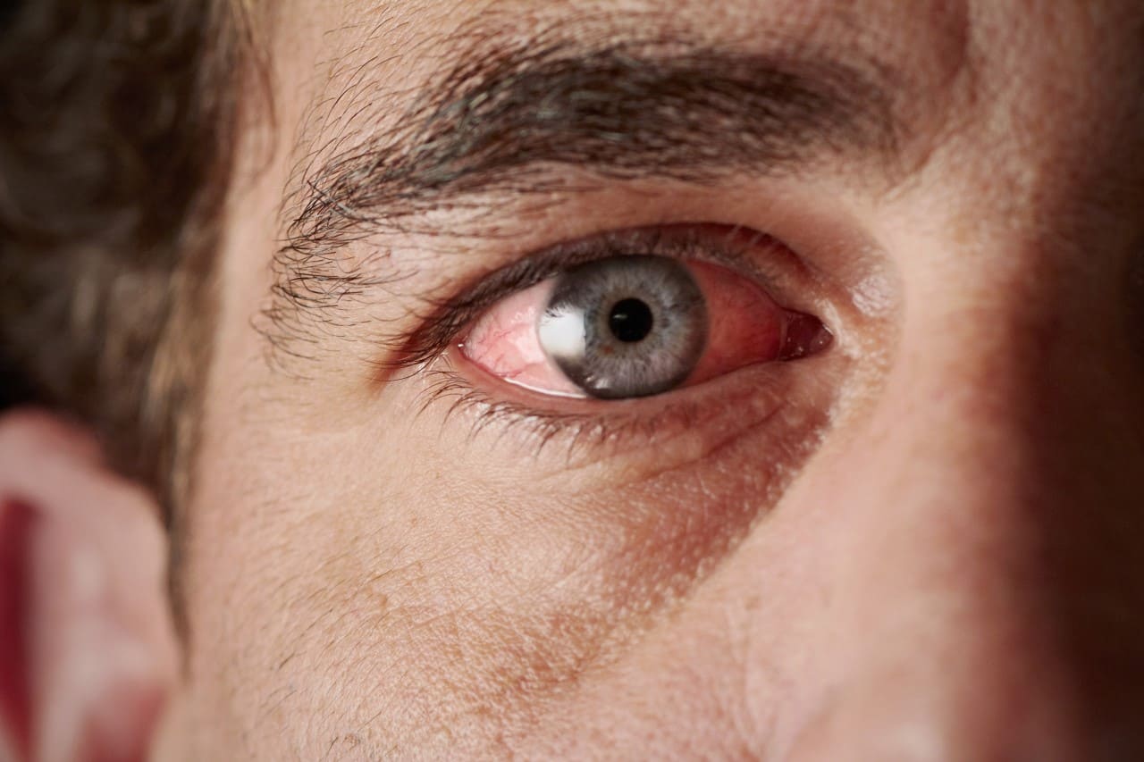 ¿Qué hacer si presentas ojo rojo? Conoce los signos de alerta y ...